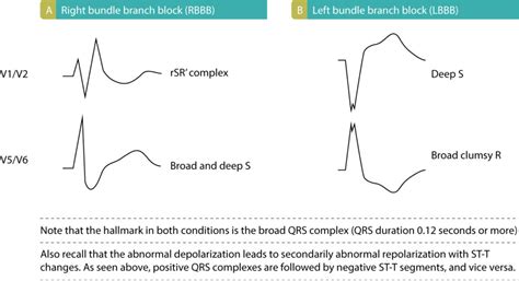 Intraventricular Conduction Delay Bundle Branch Blocks And Fascicular Blocks The Cardiovascular
