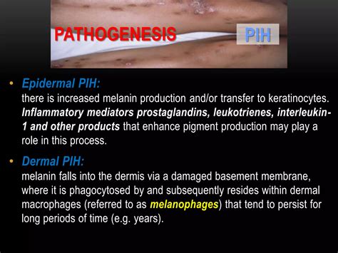 Disorders Of Hyperpigmentation Pptx