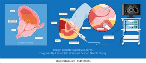 Transurethral Resection Prostate Stricture Urine Bladder Stock Vector