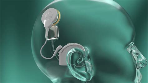 Cochlear™ Nucleus® Nexa™ System The Worlds First And Only Smart