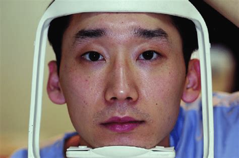 A Fixation Support For Use When Taking Gaze Photographs The Patients