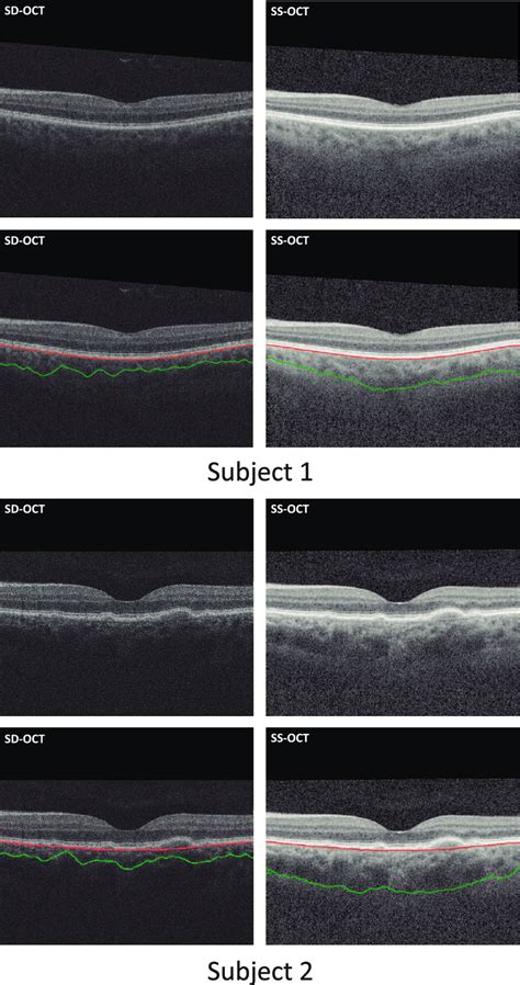 Two Examples Of Subjects In Whom The Proposed Choroidal Segmentation Of Download Scientific