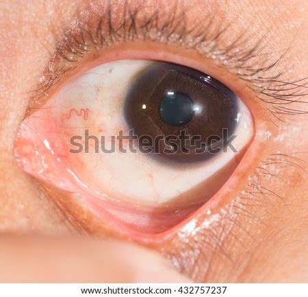 Episcleritis Stock Photos Royalty Free Images Vectors Shutterstock