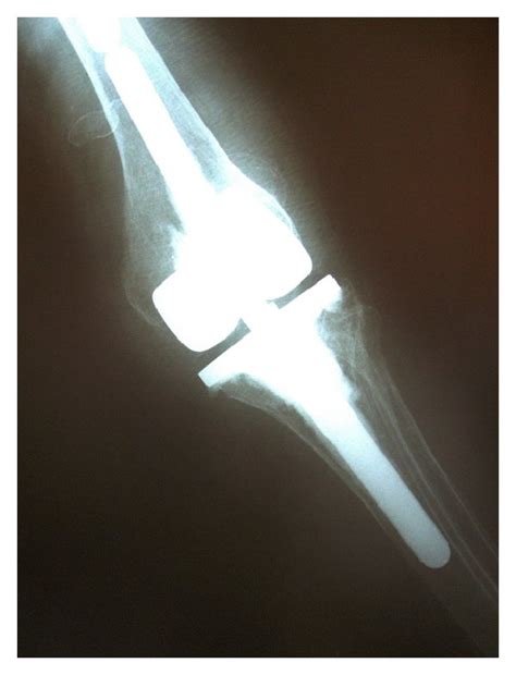 Radiography Of The Hinged Knee Prosthesis Was Satisfactory Download Scientific Diagram