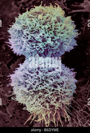 Cervical Cancer Cell Coloured Scanning Electron Micrograph Sem Of A Cultured Cancer Cell