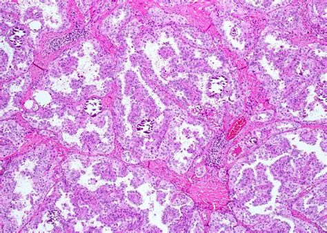 Papillary Carcinoma Thyroid Psammoma Bodies