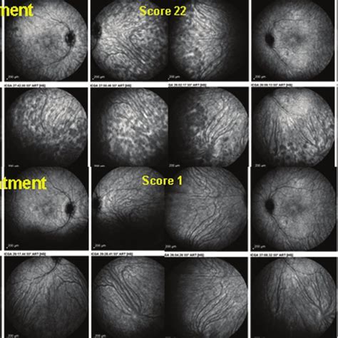Icga Monitoring Of Choroiditis In A Case Of Vkh Vkh Patient With