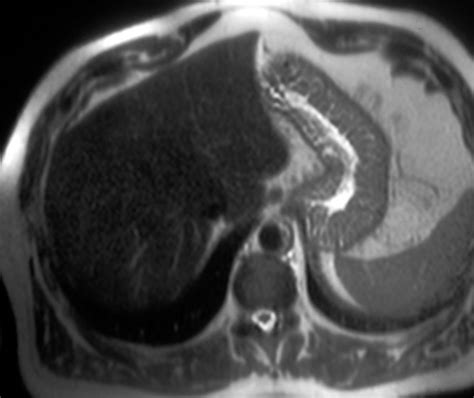 Nodular Regenerative Hyperplasia Nrh Eurorad