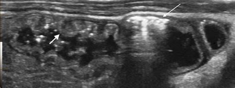 Necrotizing Enterocolitis Ultrasound