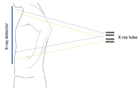 Figure 1 From Improving Osteoporotic Vertebral Deformity Detection On Chest Frontal View