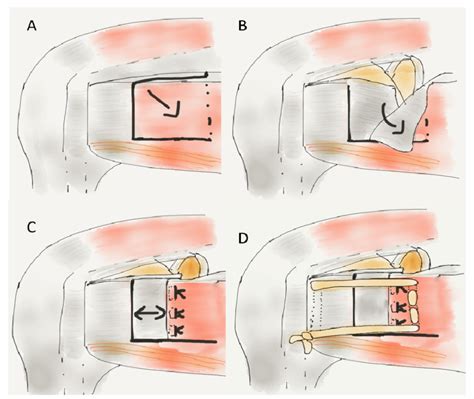 A Coronal Based Subscapularis Tenotomy A The Tenotomy Is Made In The