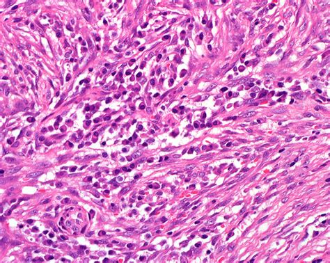 Figure 2 From Spindle Cell Sarcomas Semantic Scholar