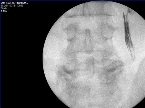 Lumber Plexus Catheter And Contrast Ppt