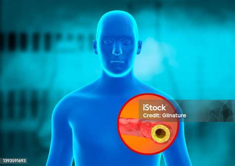 Hologram Biru Tubuh Manusia Aterosklerosis Adalah Penumpukan Plak Kolesterol Di Dinding Arteri