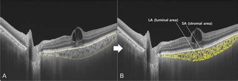 The Choroidal Vascularity Index Cvi Measuring Process With
