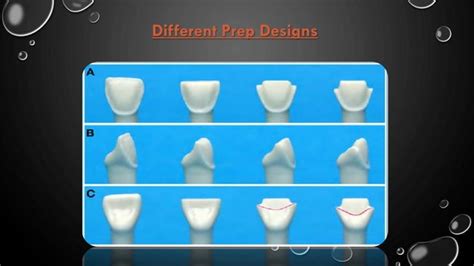 Partial Coverage Restorationspdf