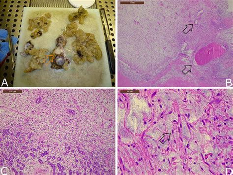Report Of Two Primary Renal Tumors With Myxoid Features Differential