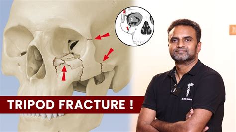 Tripod Fracture Xray