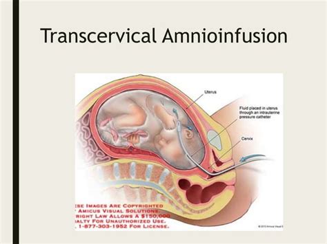 375171980 Amnio Infusionpptx Pregnancy Reproductive Health