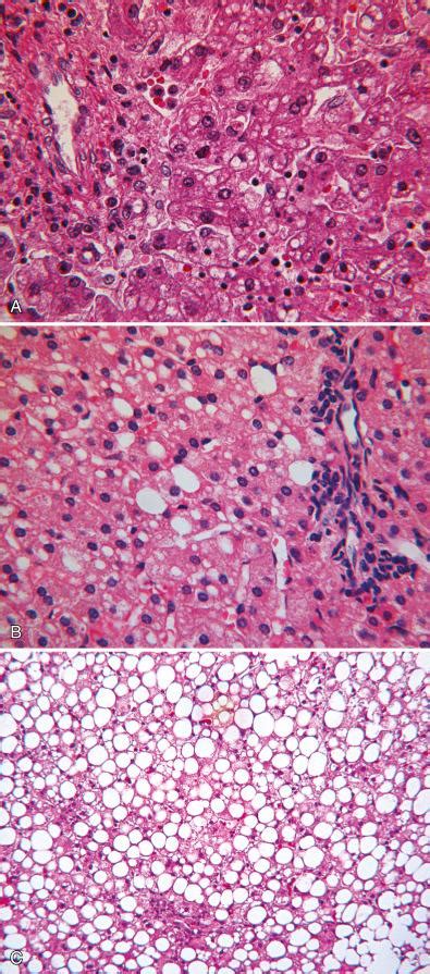 Histologic Patterns Of Metabolic Liver Diseases Clinical Tree