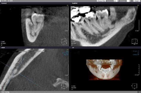 Esthetic Ceramic Veneers For Spaced Anterior Teeth Utilizing The Red