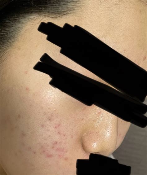 여드름 흔적 피부 문제 지식in