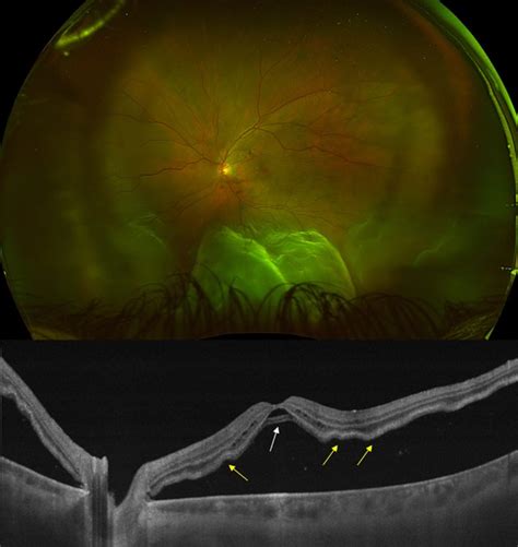 A Novel Finding In Fovea Off Rhegmatogenous Retinal Detachment A Bacillary Layer Detachment