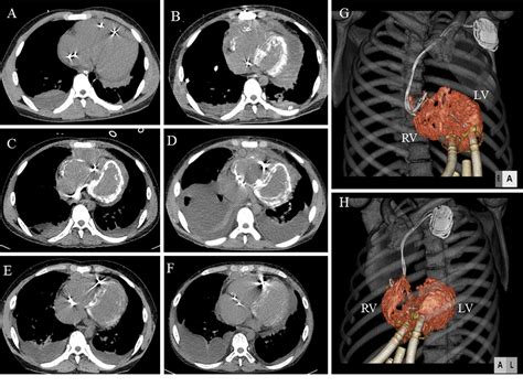 Figure 2 From Massive Biventricular Myocardial Calcification In A Patient With Fulminant