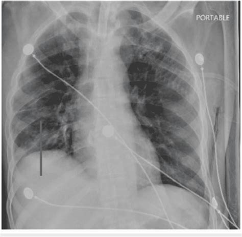 Chest X Ray Showing Patchy Bilateral Airspace Disease Greatest In The Download Scientific