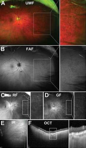 Full Article Visualisation Of Peripheral Retinal Degenerations And