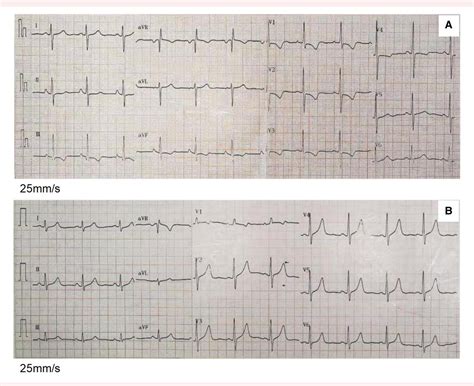 Figure From A Babe Woman Presenting With Dyspnoea And Diffuse T Wave Inversions A Case