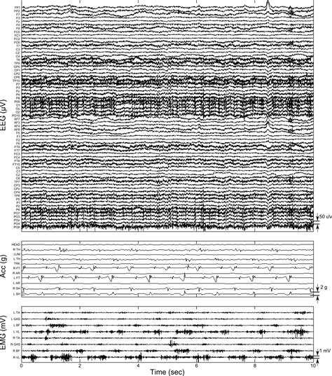 Simultaneous Scalp Electroencephalography Eeg Electromyography Emg