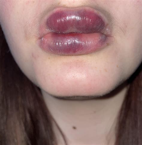 Lip Filler Gone Wrong Rplasticsurgery
