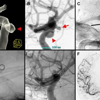 Pipeline Embolisation Device PED Treatment Of Two Right Sided Download Scientific Diagram