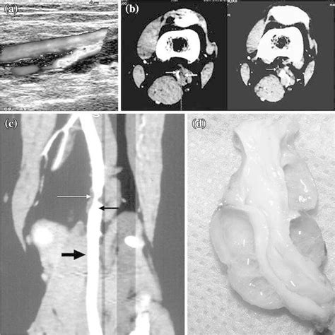Case 1 A 49 Year Old Man With Cystic Adventitial Disease Cad Of The Download Scientific