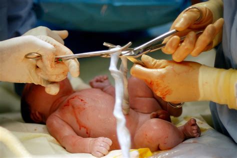 Cord Bilirubin Predicts Hemolysis Risk In Rh Incompatibility Rare