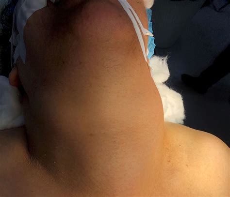 Large Toxic Multinodular Goitertotal Thyroidectomy Jun 2021 Dr Raad Al Saffar