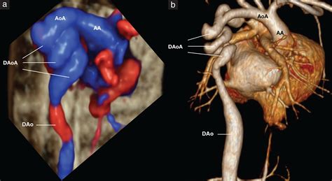 Fetal Descending Aortic Tortuosity With Ductal Aneurysm Karmegaraj