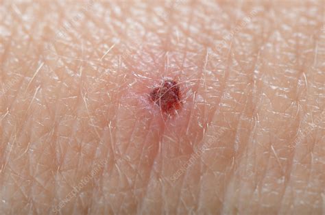 Scab Stock Image C Science Photo Library