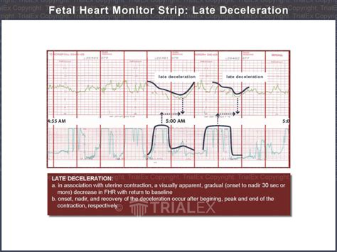 Fetal Heart Monitor Strip Late Deceleration Trialquest Inc