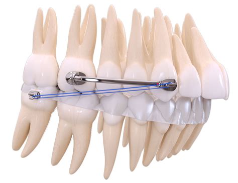 Powerbar™ Class Ii Corrector American Orthodontics Israel