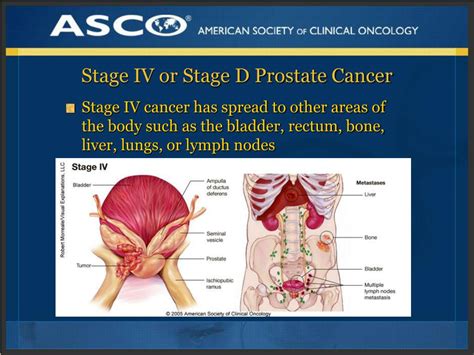 Ppt Plwc Slide Deck Series Understanding Prostate Cancer Powerpoint Presentation Id632680