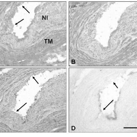 Endothelin 1 Et 1 And Proliferating Cells In Conventionally Prepared