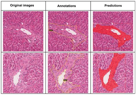 Instance Segmentation Test Results For Hepatic Fibrosis Trained Using Download Scientific