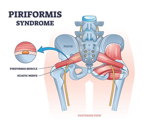 Piriformis Syndróm Príznaky Príčiny A Liečba Bolesti Sedacej Oblasti Zdravotekask