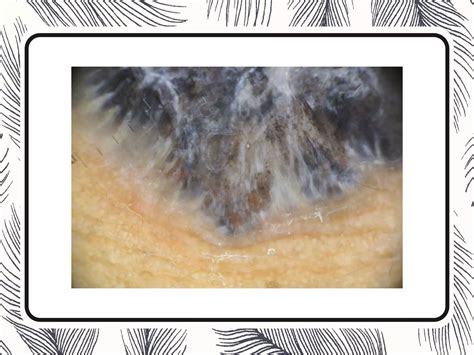 Dermoscopy Bccmbosseila2018 Ppt