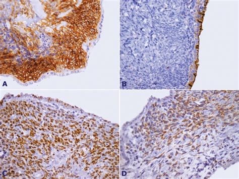 Ovarian Adenosarcoma Simulating A Simple Cyst In A Young Patient Pmc