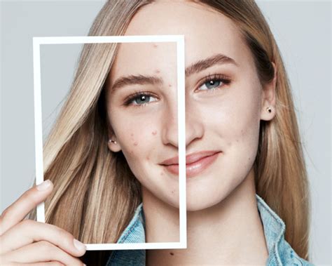 The Dos And Donts Of Making Pimples Go Away