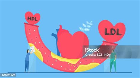 심장 벡터 그림입니다 이 질병은 동맥 경화증으로 인한 관상 동맥의 협연입니다 더 많은 콜레스테롤과 지방 예금 Ldl 값은 Hdl 이상입니다 건강관리와 의술에 대한 스톡 벡터
