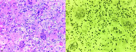 A Multinucleated Osteoclast Giant Cells With Large Number Of Nuclei